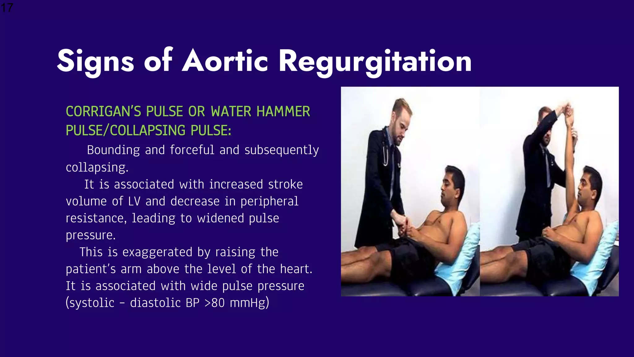 Aortic Regurgitation.pptx