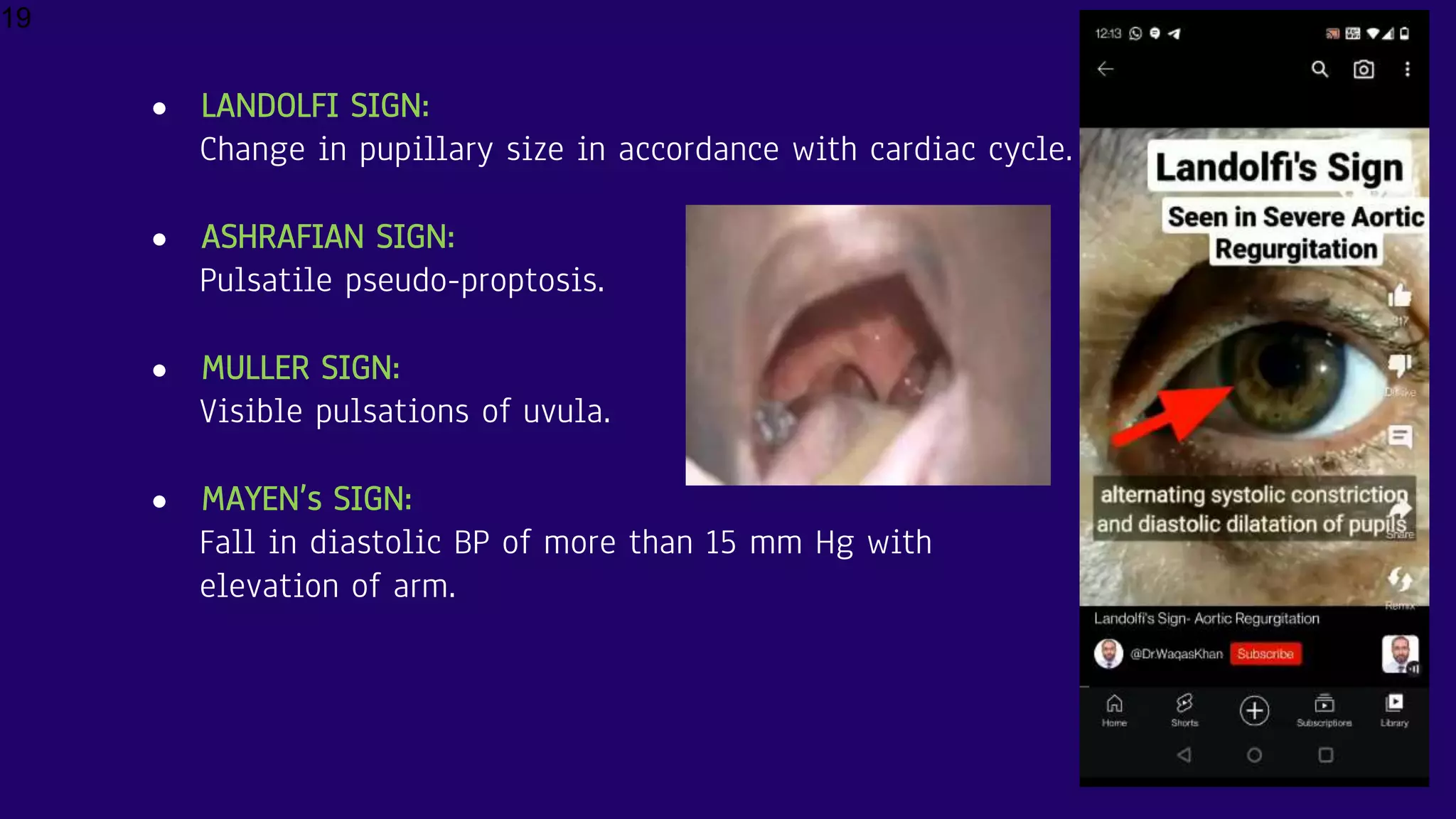 Aortic Regurgitation.pptx