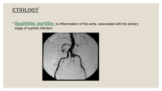 Ppt for medical college aortic regurgitation.pptx