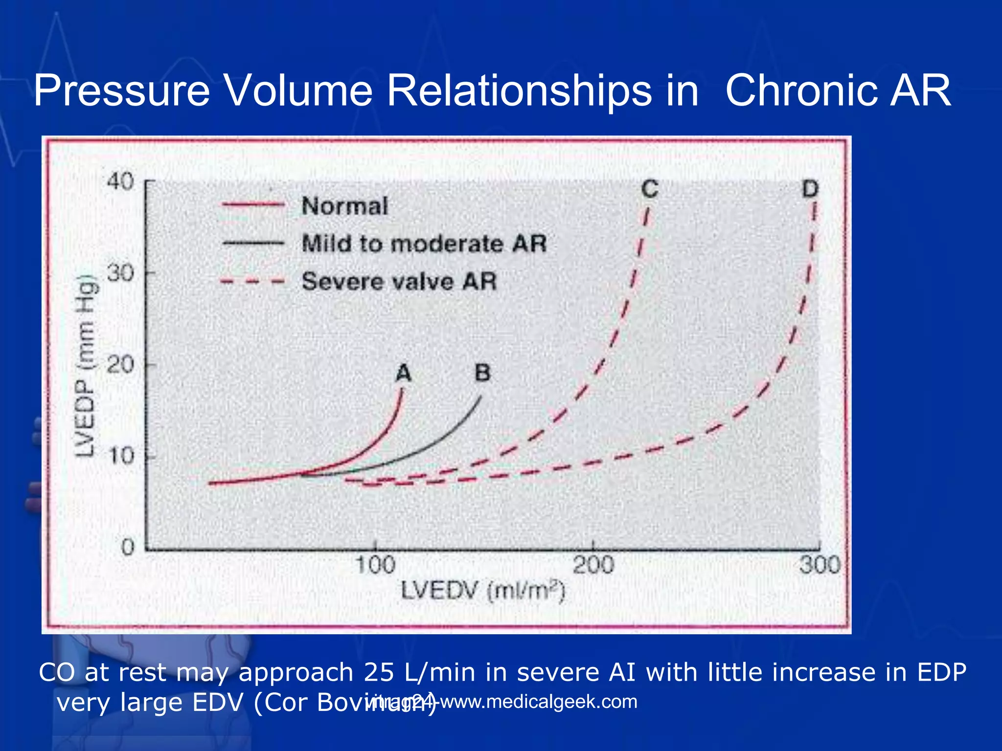 Aortic regurgitation | PPTX