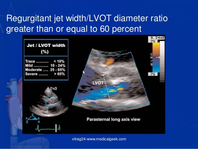 Aortic regurgitation