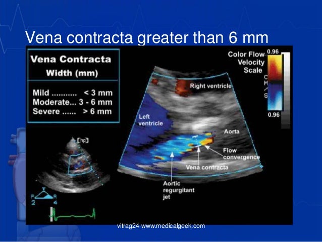 Aortic regurgitation