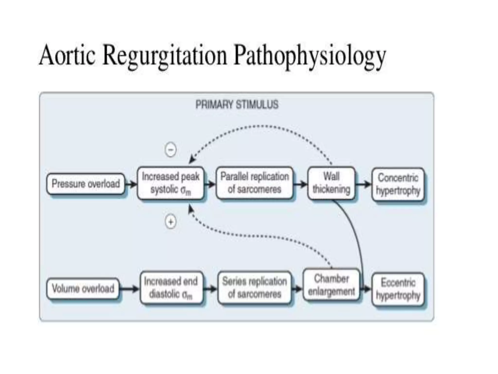 Aortic regurgitation pathophysiology | PPT