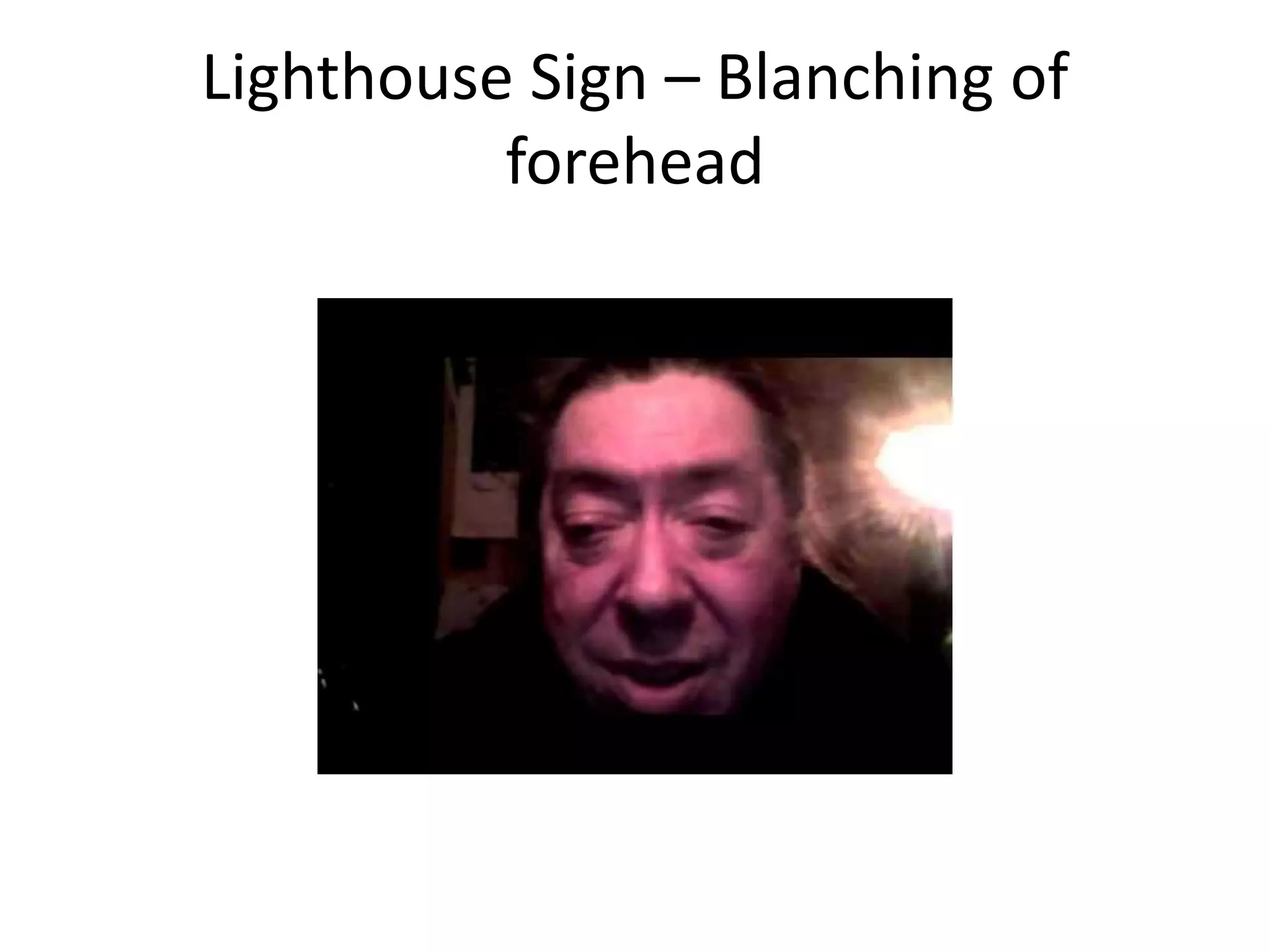 Aortic regurgitation pathophysiology | PPTX