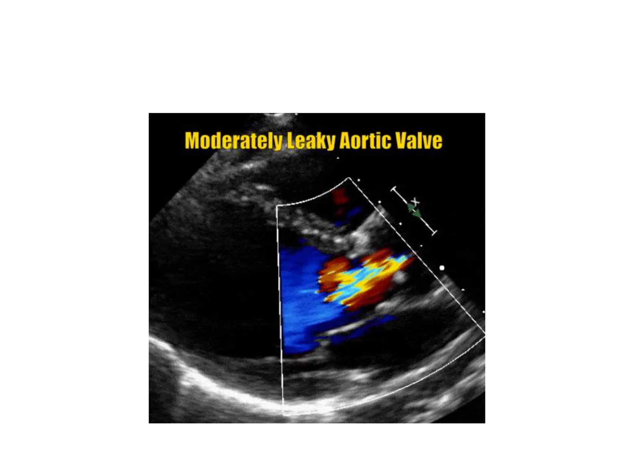 Aortic regurgitation pathophysiology | PPTX