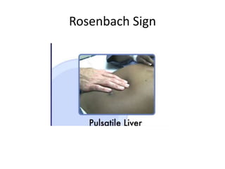 Aortic regurgitation pathophysiology | PPT