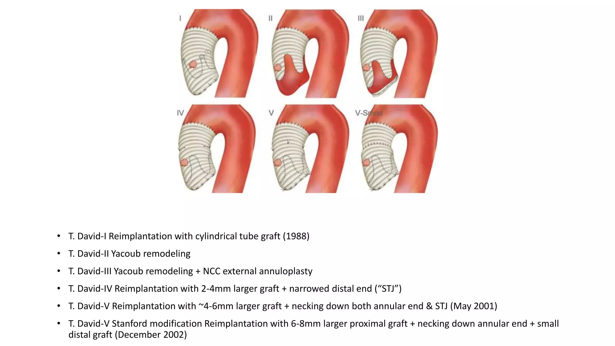 Aortic repair ppt | PPTX