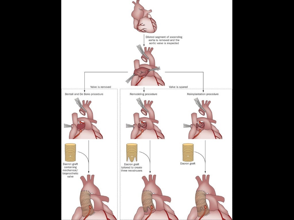 Aortic root surgical anatomy