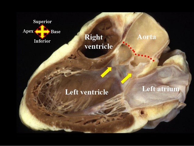 Aortic root surgical anatomy
