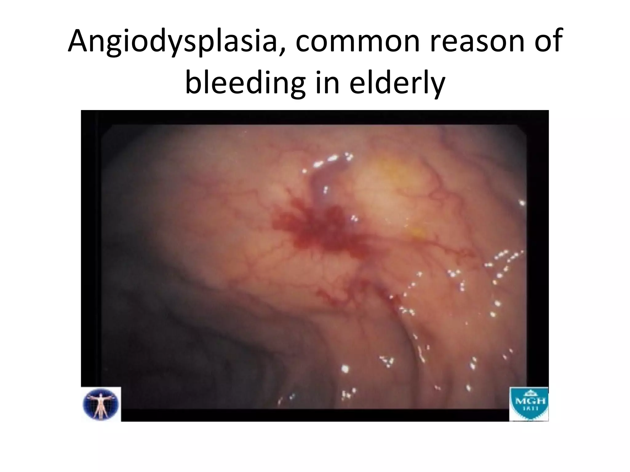 Aortic Stenosis& anemia | PPT