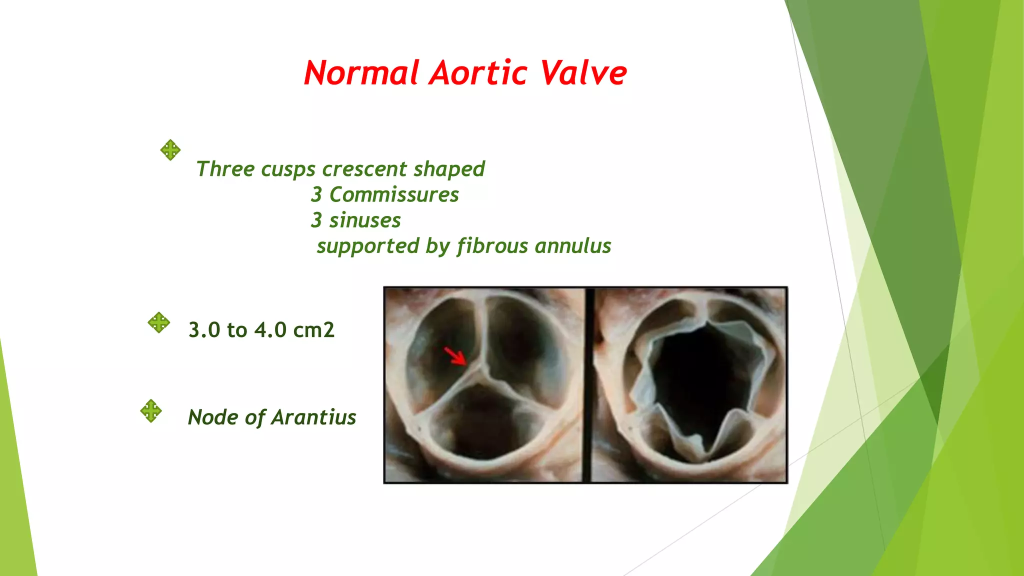Aortic stenosis | PPTX