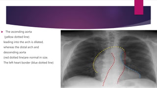 Aortic stenosis | PPTX