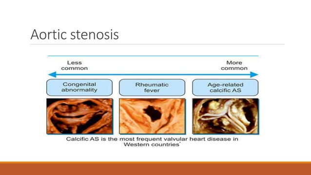 AORTIC STENOSIS.pptx