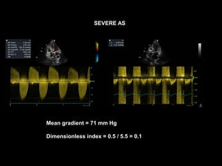 Aortic Stenosis.ppt