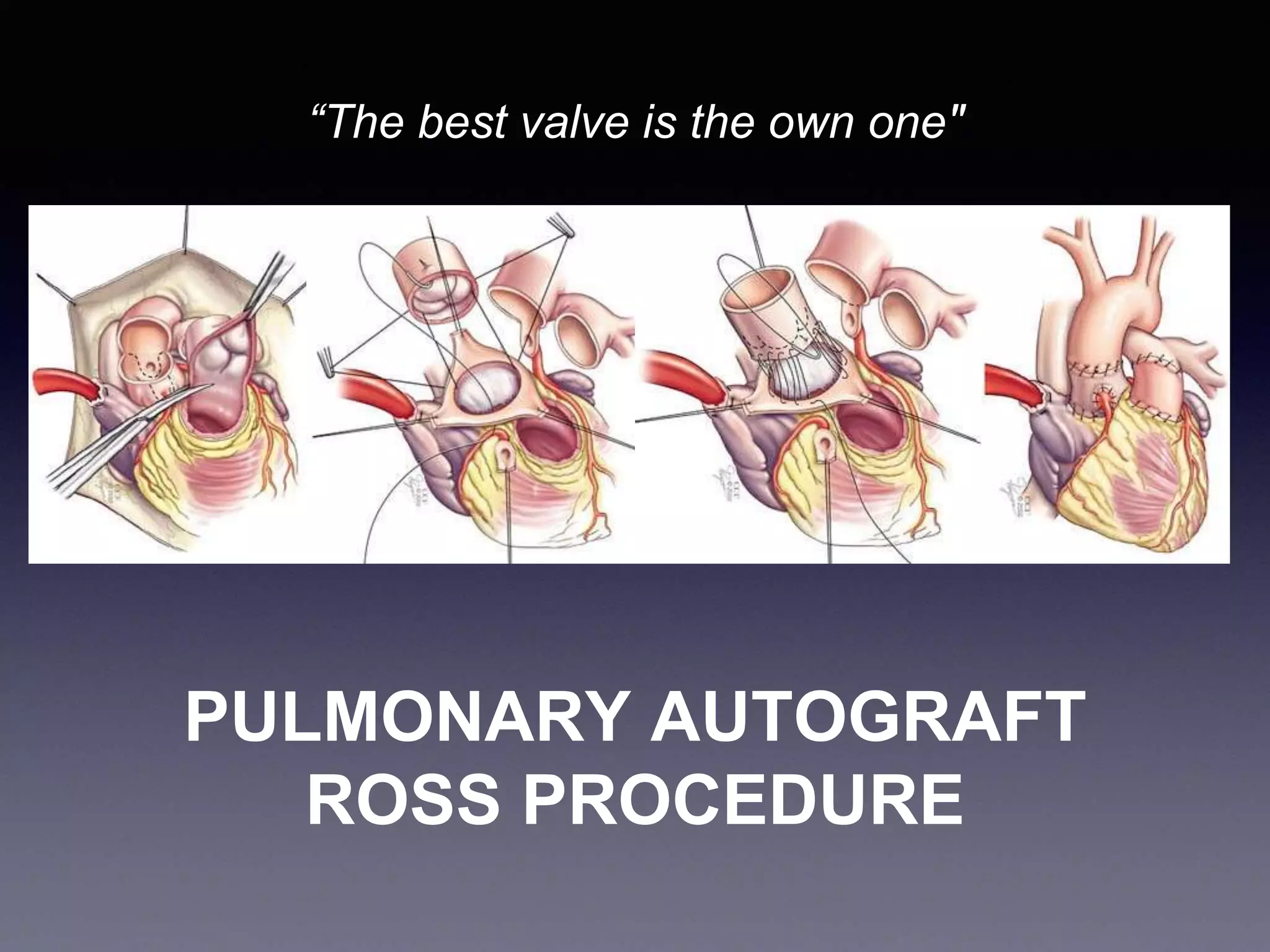 Aortic stenosis and aortic valve replasement | PPT