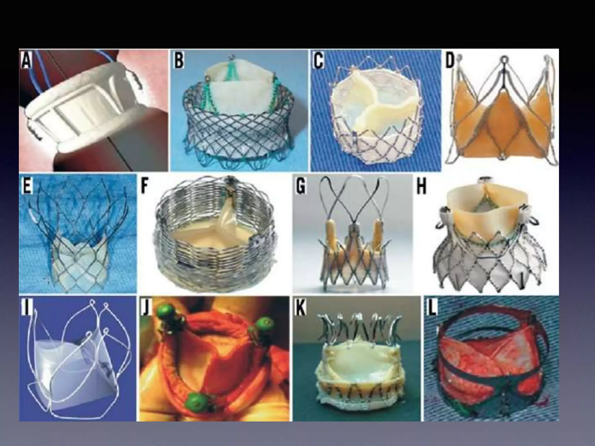 Aortic stenosis and aortic valve replasement | PPT