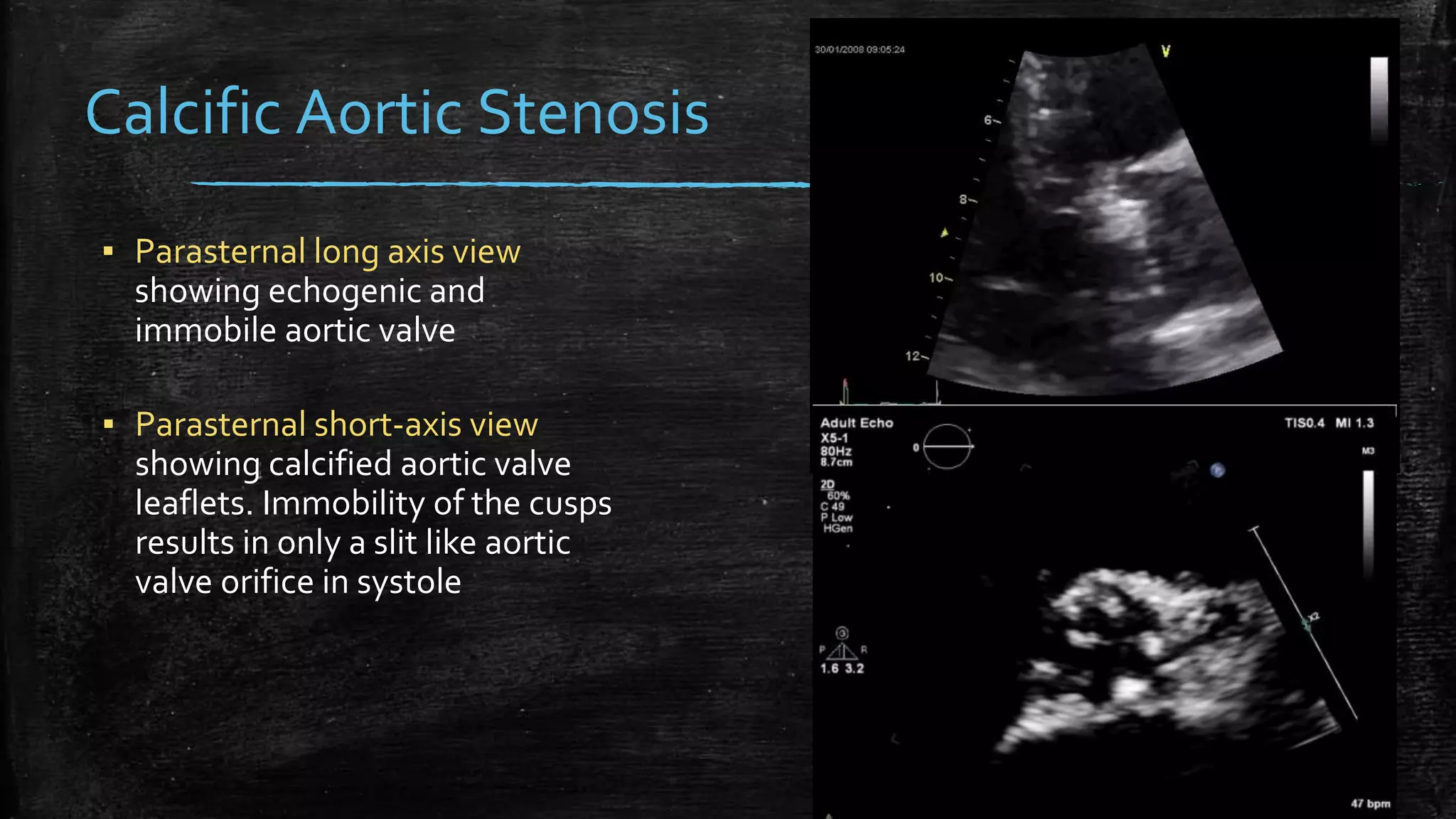 Echocardiography of Aortic stenosis | PPTX