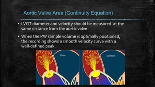 Echocardiography of Aortic stenosis | PPTX