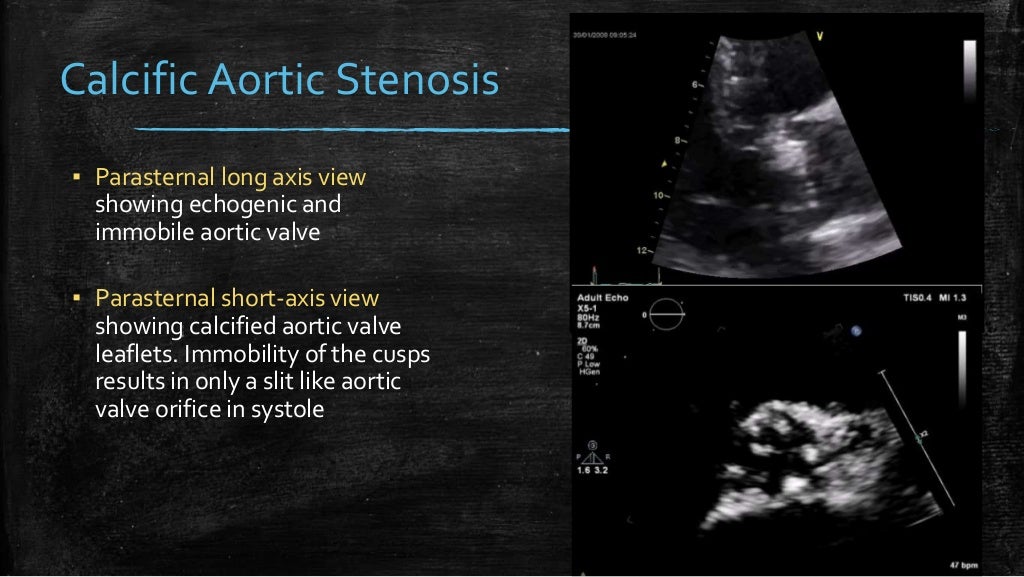 Echocardiography of Aortic stenosis