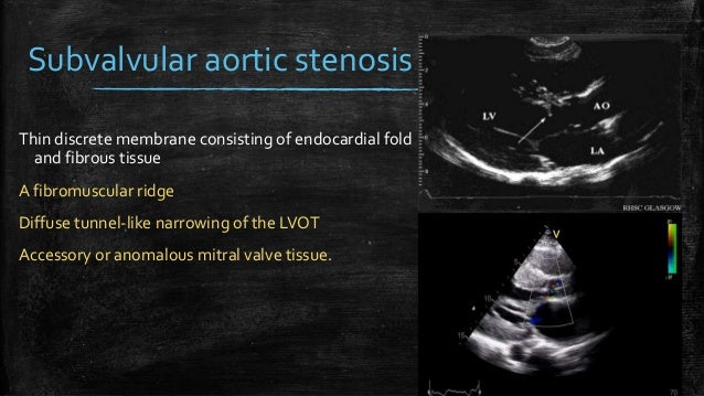 Echocardiography of Aortic stenosis