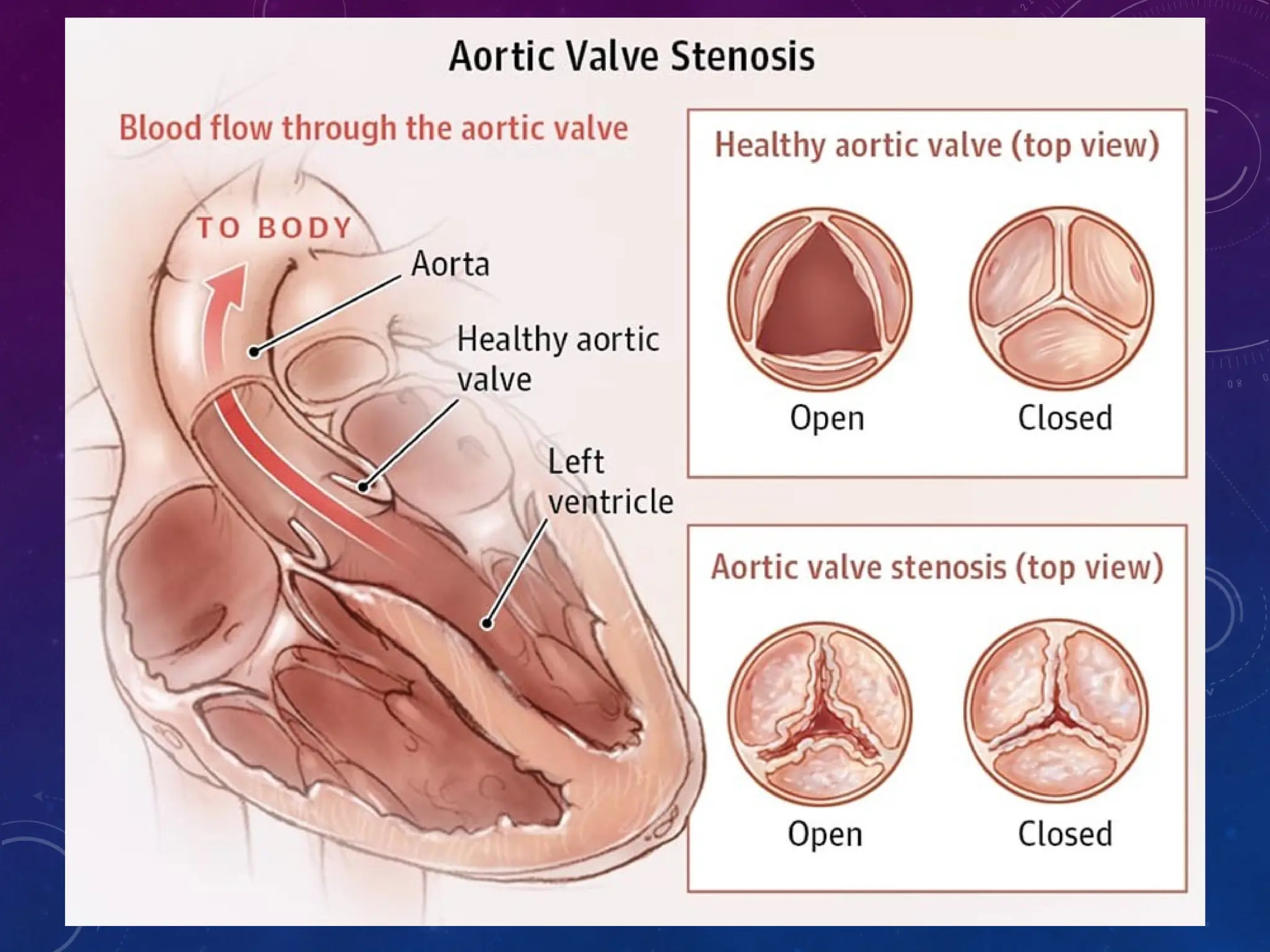Aortic Stenosis and other valvular disorders.ppt