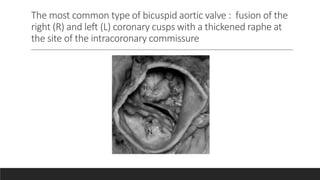 Aortic valve | PPTX