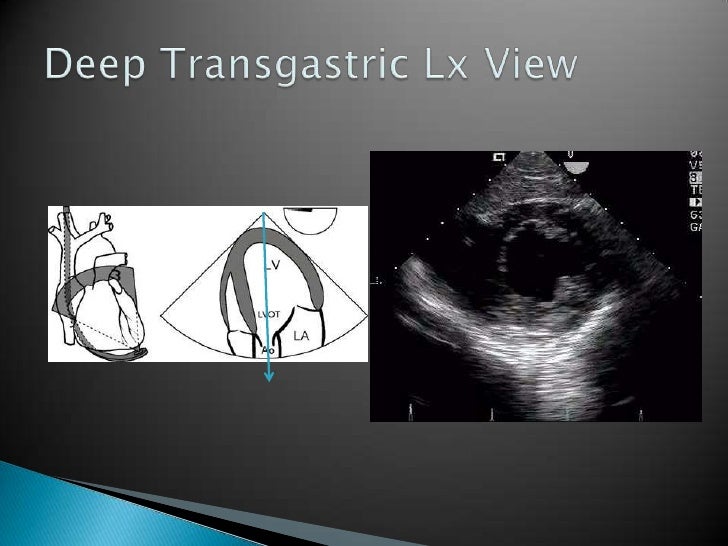 Aortic valve assessment