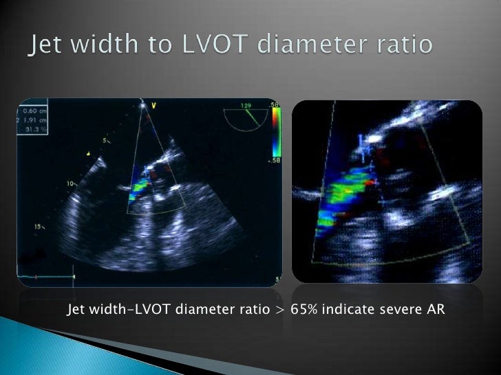 Aortic valve assessment