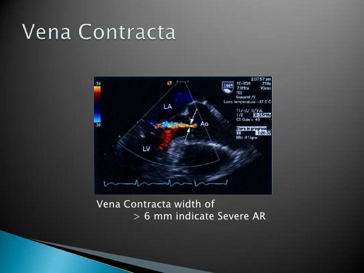 Aortic valve assessment