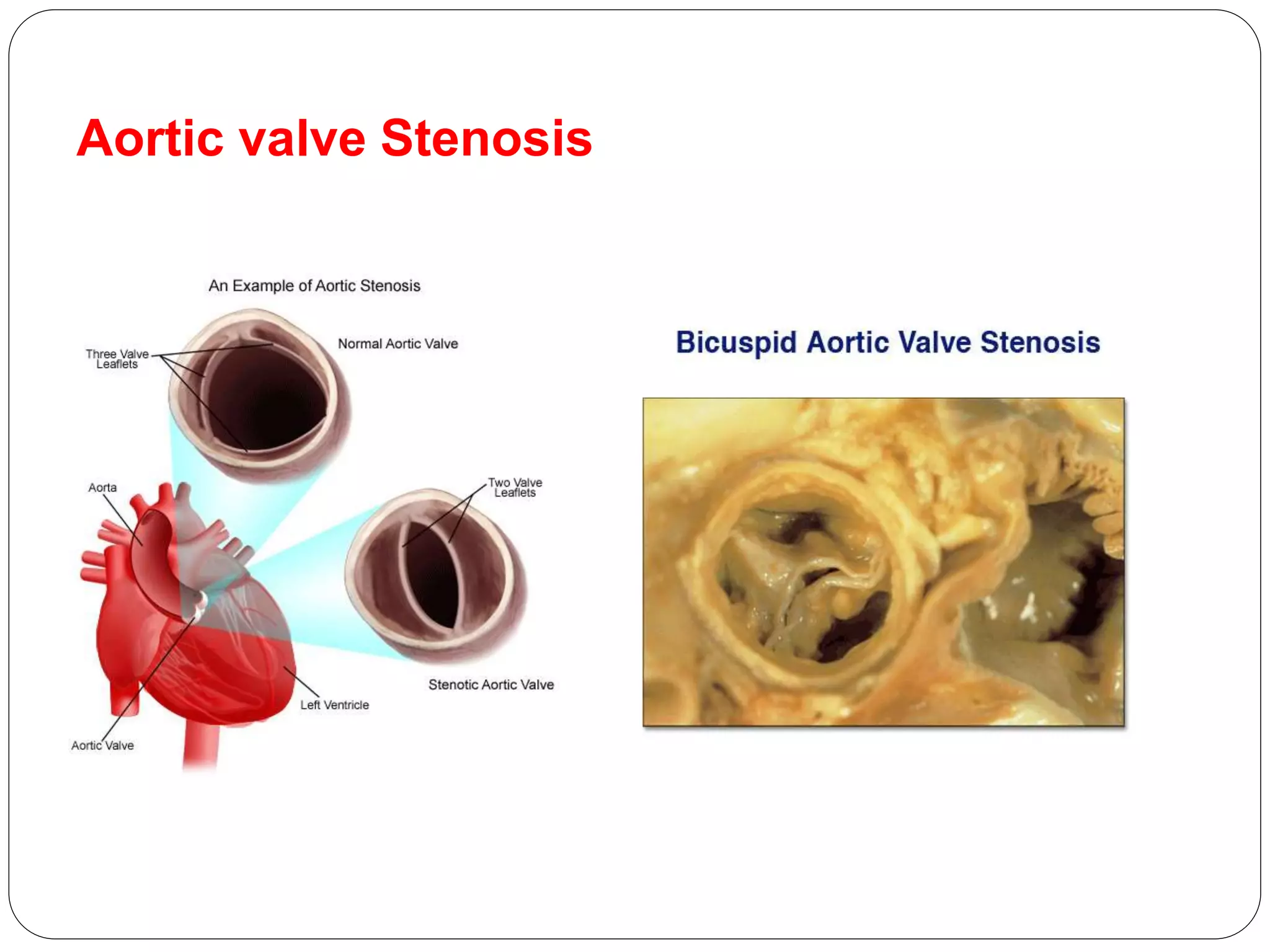 Aortic valve disease | PPTX