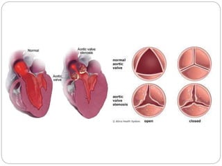 Aortic valve disease | PPTX