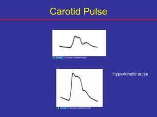 Aortic valvedisease | PPTX