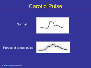 Aortic valvedisease | PPTX