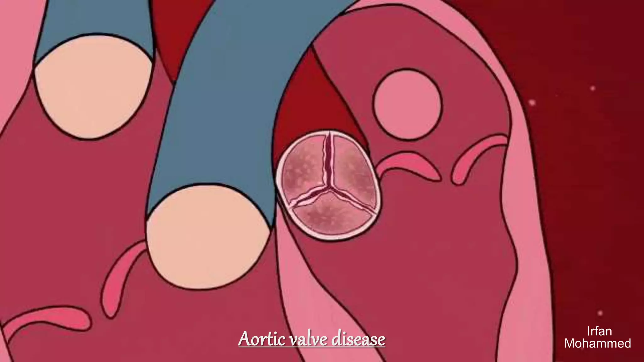 aortic valve disease.pptx