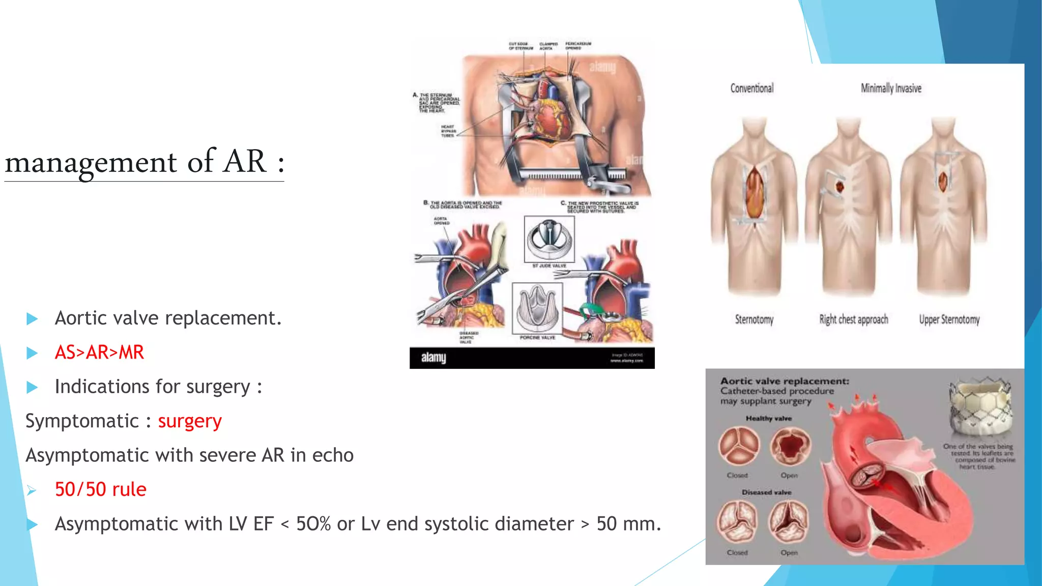 aortic valve disease.pptx
