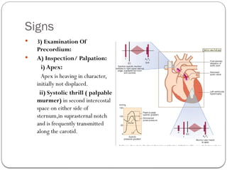 Aortic Valve Diseases fdsfgsrdfd (1).pptx