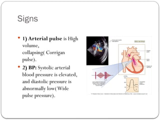 Aortic Valve Diseases fdsfgsrdfd (1).pptx