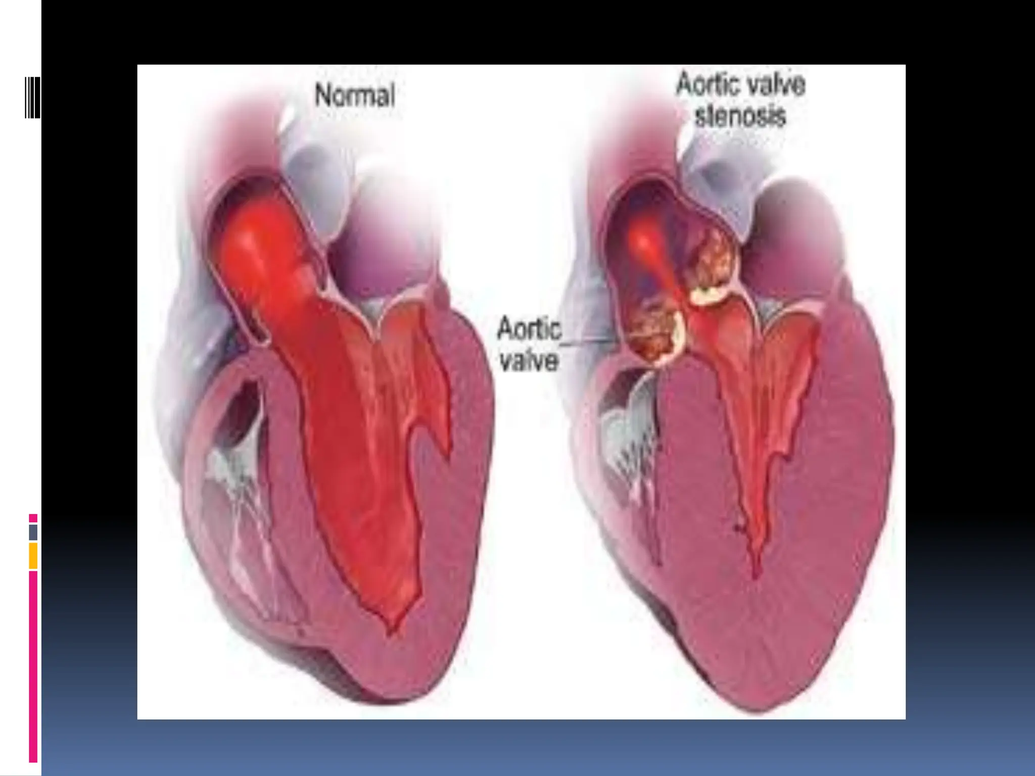 AORTIC VALVE DS.pptx | Heart and Cardiovascular Diseases | Diseases and ...