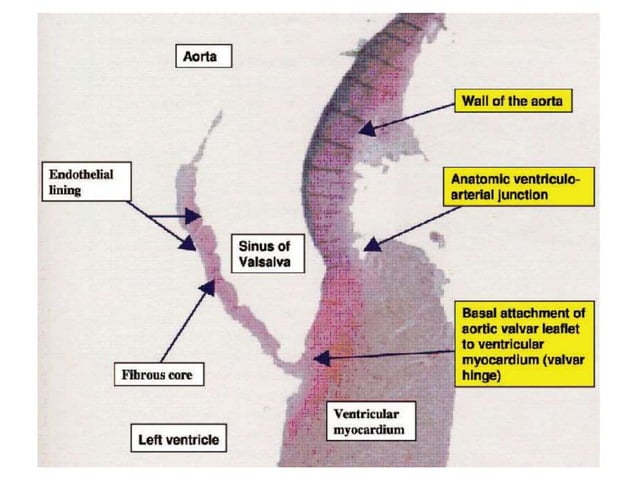 Aortic valve anatomy presentation | PPTX | Heart and Cardiovascular ...