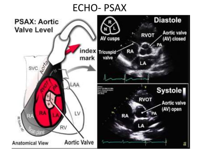 Aortic valve anatomy presentation | PPTX | Heart and Cardiovascular ...