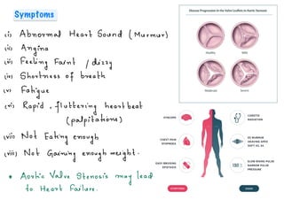 Aortic Valve Stenosis.pdf
