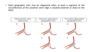 Aorto-Ostial Lesions.pptx