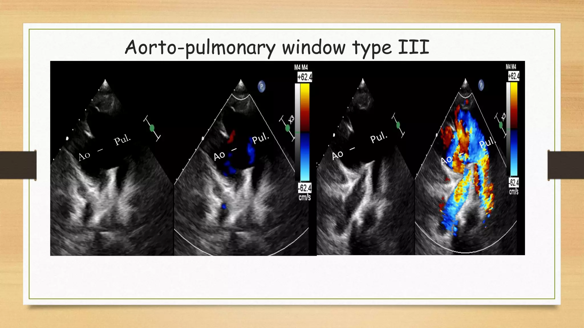 Aorto pulmonary window may 2021 | PDF