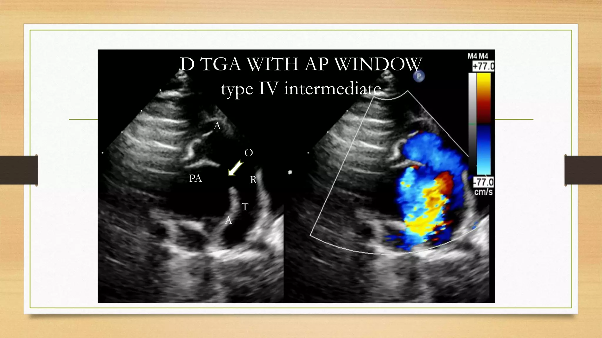 Aorto pulmonary window may 2021 | PDF