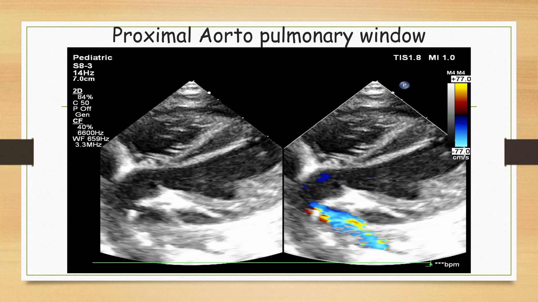 Aorto pulmonary window may 2021 | PDF