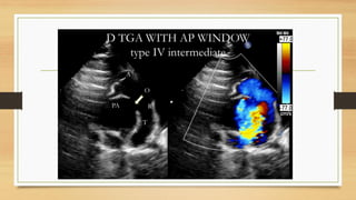 Aorto pulmonary window may 2021 | PDF