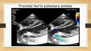 Aorto pulmonary window may 2021 | PDF