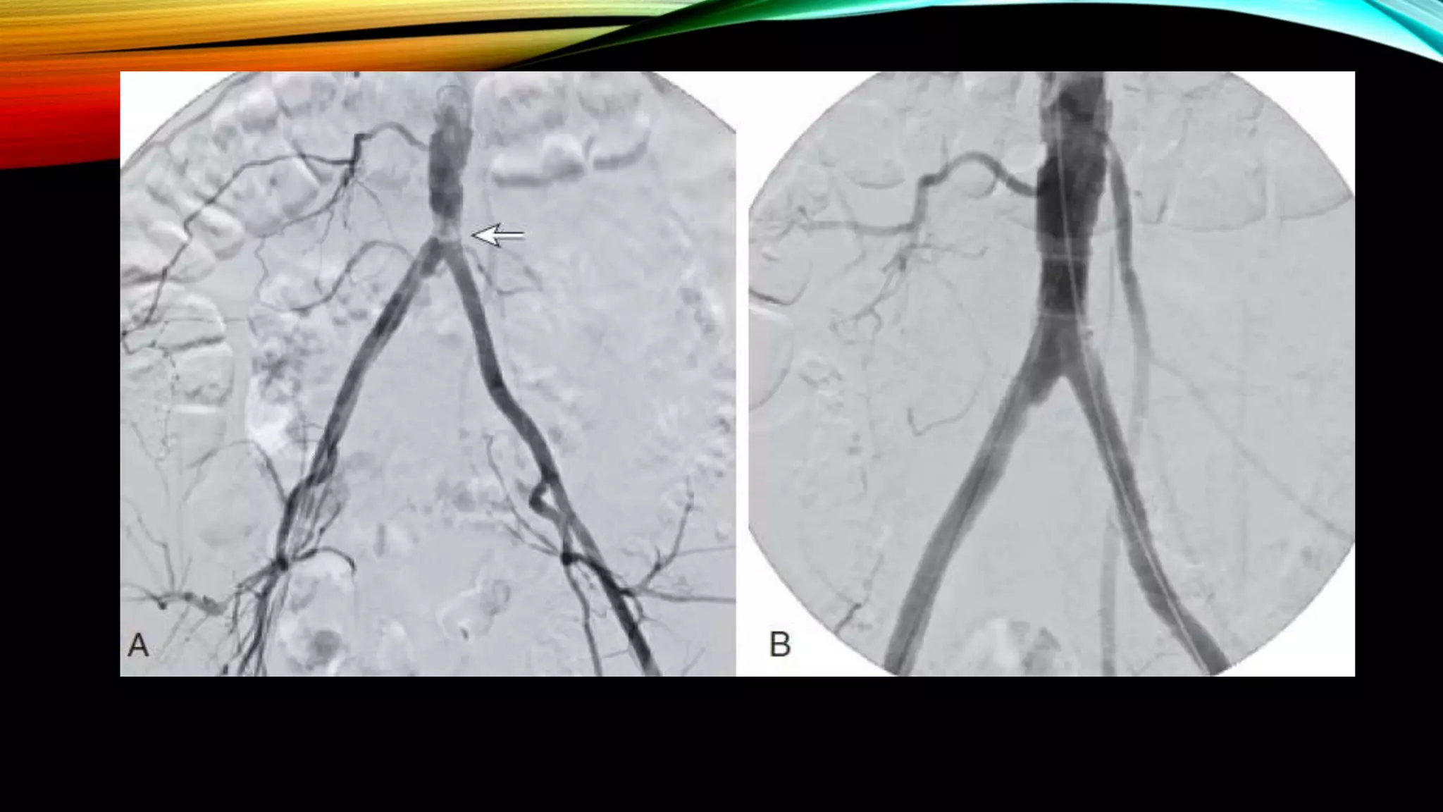 Aorto iliac interventions | PPTX