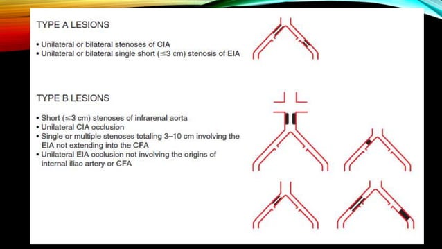 Aorto iliac interventions | PPTX | Heart and Cardiovascular Diseases ...
