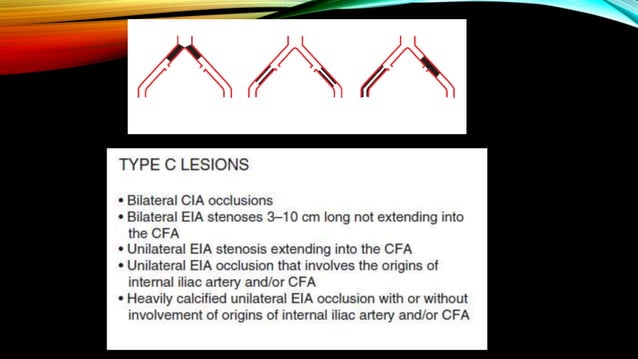 Aorto iliac interventions | PPTX | Heart and Cardiovascular Diseases ...
